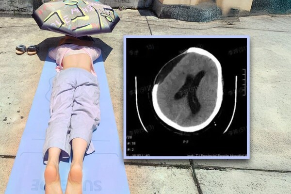 Chinese woman in coma after folk remedy leads to brain hemorrhage